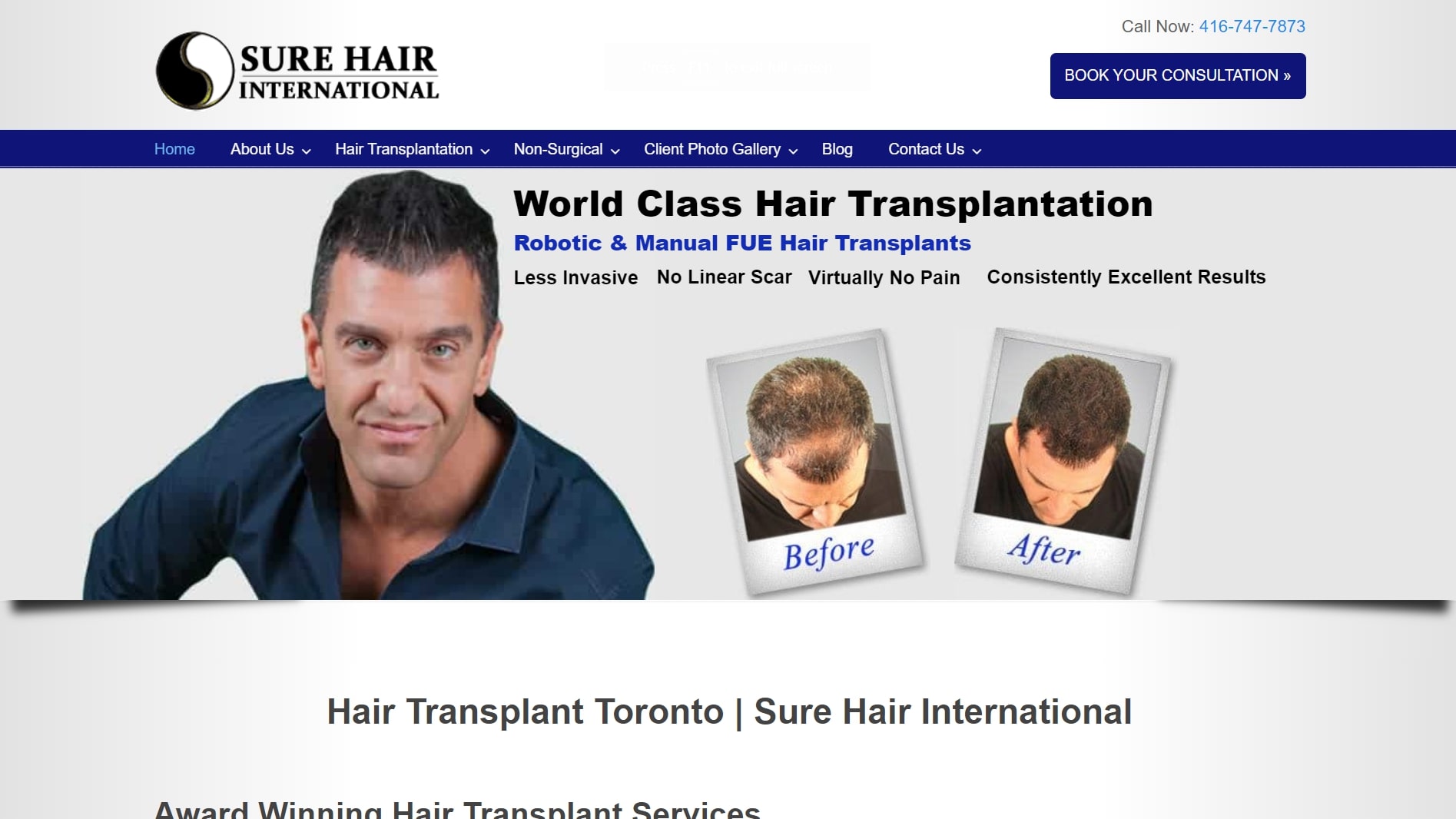 Where to Get Hair Transplants in Toronto [Our Top 5 Picks!] [2026]